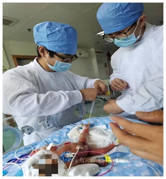 A 560-gram premature baby with a hand size of 560 grams makes his way ...