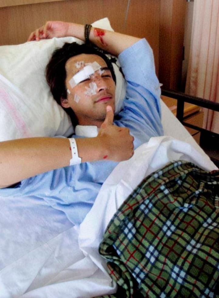 Hu Ge showed off the scar on his right eye and recalled the car ...