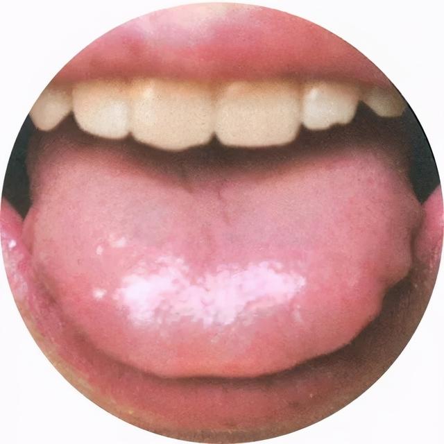 tcm teeth marks on tongue