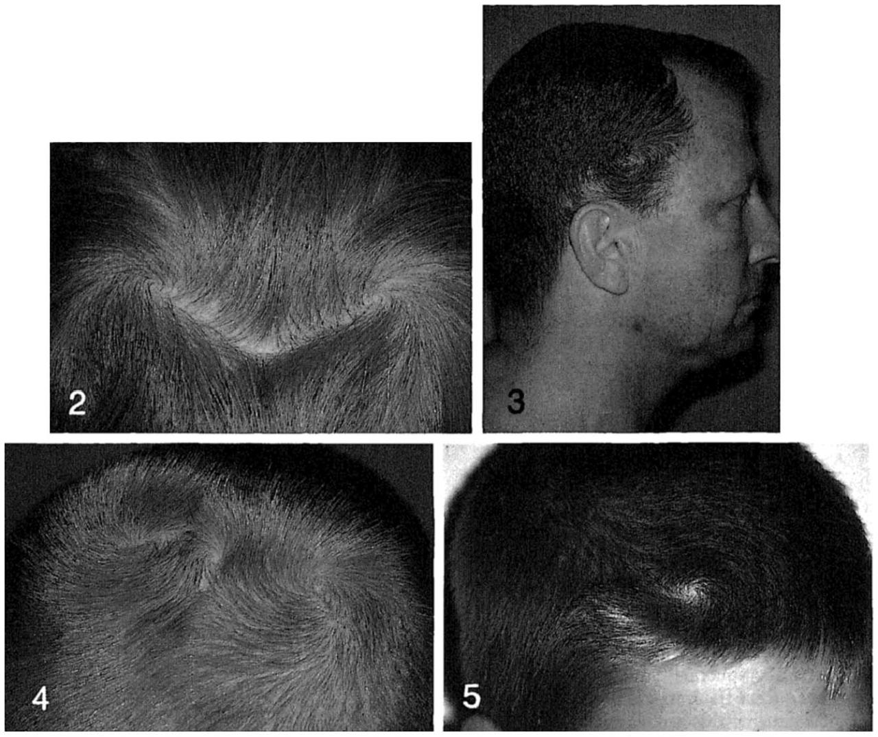 Why does everyone have a whorl in their hair? Are people with two ...