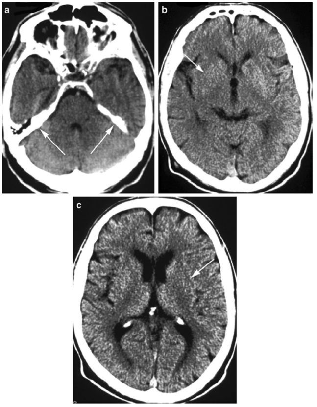 Reading CT scans of acute stroke is not difficult but not easy either ...
