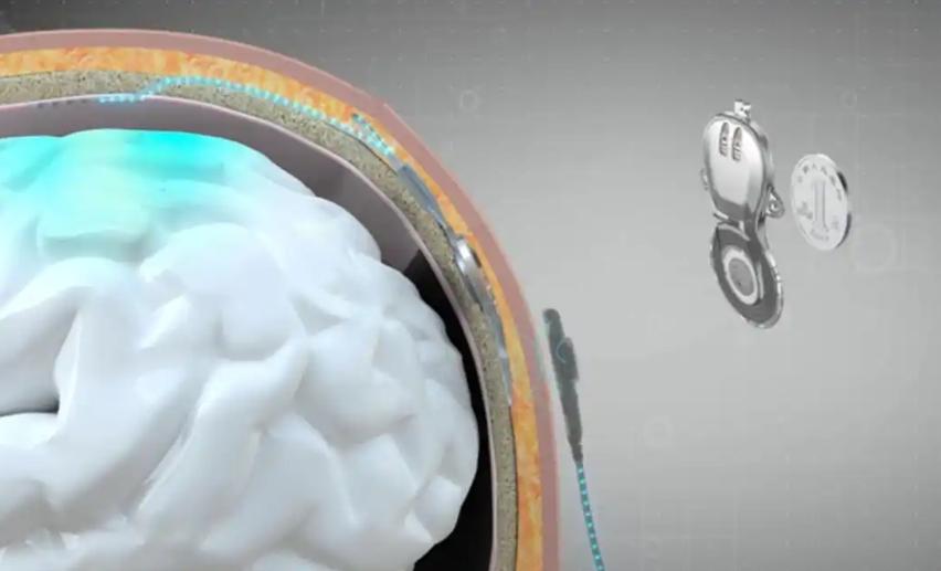 Tsinghua University Hongbo Team: Wireless minimally invasive implantable brain-computer ...